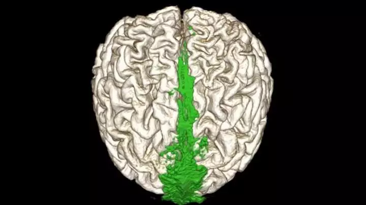 Уцечка мазгоў: упершыню сканіраванне паказвае сістэму ўтылізацыі адходаў мозгу