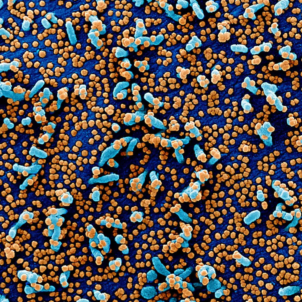 Новые изображения показывают, что новый коронавирус «убивает» человеческую клетку 1957_1