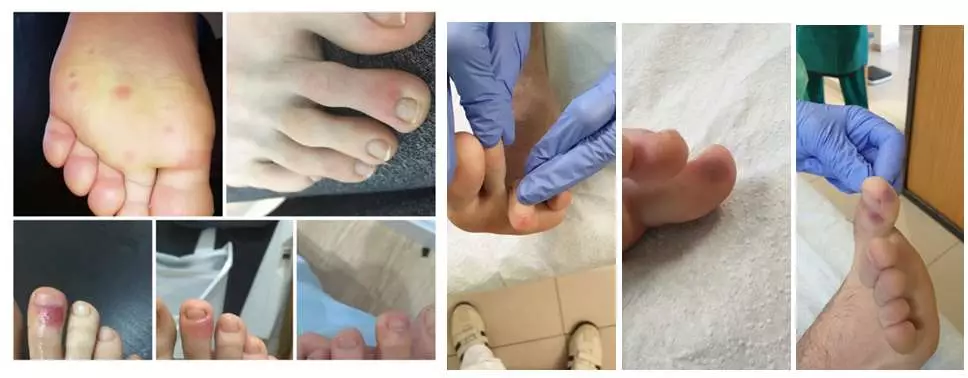 Lesions als peus reportades com a símptoma de Covid-19 en nens, alguns adults 2180_1