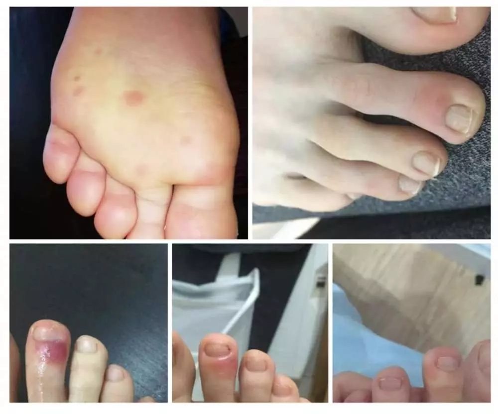 Lesions als peus reportades com a símptoma de Covid-19 en nens, alguns adults 2180_2