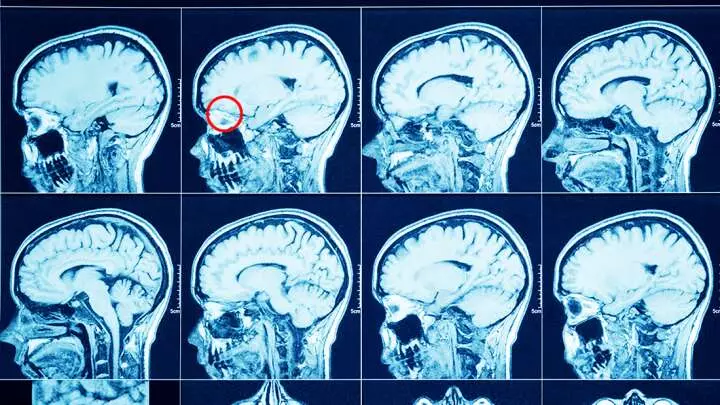 As resonancias magnéticas mostran signos de "invasión cerebral viral" nun paciente con Covid-19