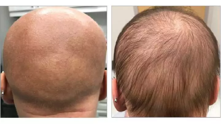 Alopeetsiaga teismeline kasvatab tänu uuele ekseemiravimile ootamatult juuksed tagasi