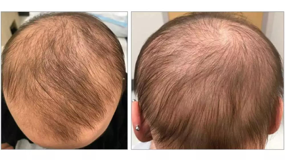 Déagóir Le Alopecia Athfhásann Gruaige Gan choinne Buíochas Le Drugaí Nua Eczema 2824_1