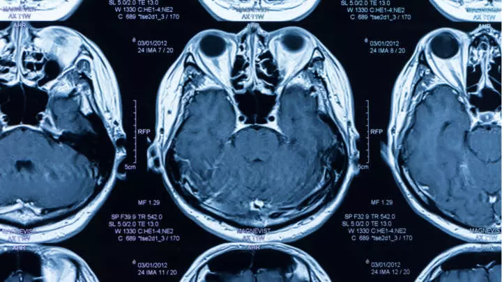 Los científicos encuentran más vínculos entre los patrones de sueño y la enfermedad de Alzheimer