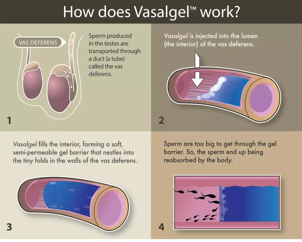 indhold-1486467313-vasalgel-infographic-