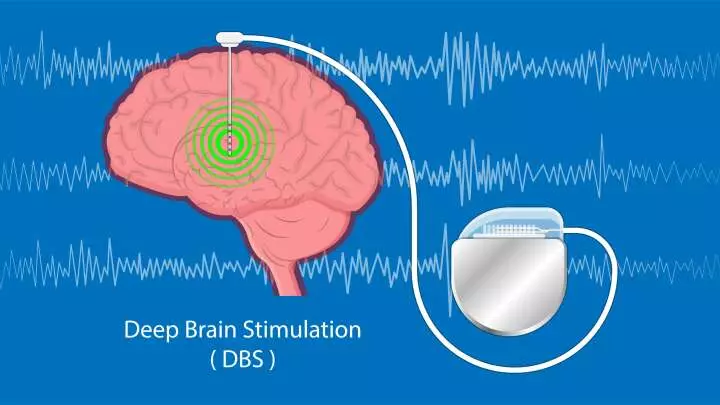 Personalisierte Tiefenhirnstimulation lindert Depressionen sofort in einer Einzelfallstudie