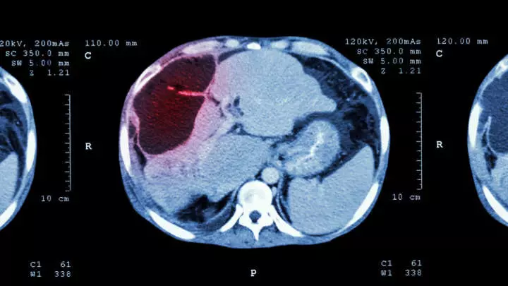 Nje Virus a na-ahụkarị nwere ike inye aka ịlụso ọrịa kansa imeju ọgụ na ịba ọcha n'anya C