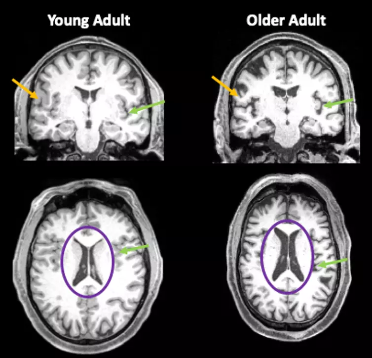 30대와 80대의 뇌 스캔, 노인 뇌에서 감소된 뇌 용적