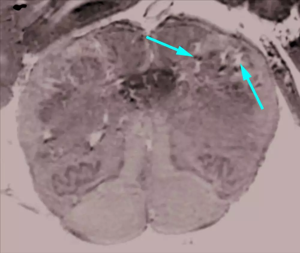 COVID vinculado a inflamación y vasos sanguíneos dañados en el cerebro 5332_1