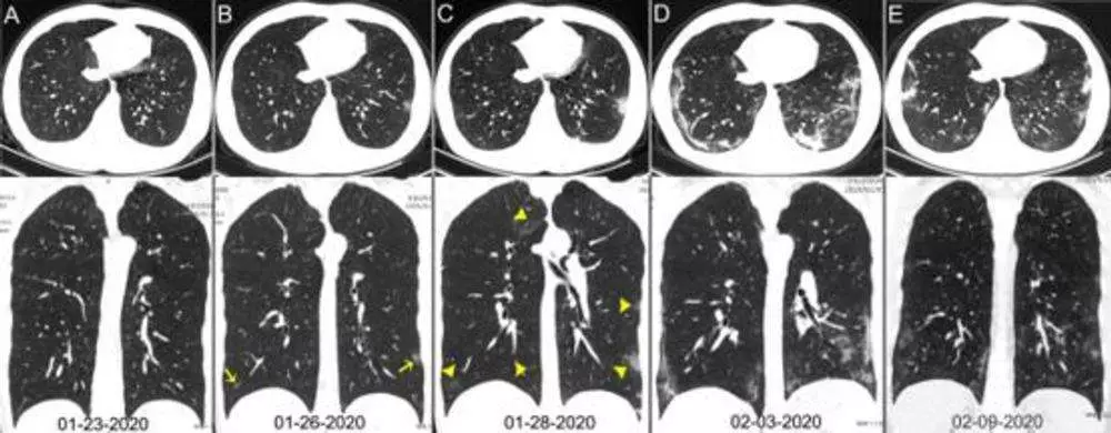 CT Scan Nuduhake Apa sing Bisa Ditindakake COVID-19 Kanggo Paru-paru Sampeyan 7819_1