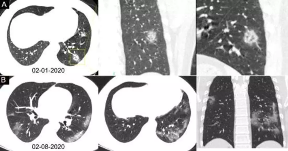 CT Scan Nuduhake Apa sing Bisa Ditindakake COVID-19 Kanggo Paru-paru Sampeyan 7819_2