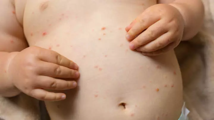 Anti-Vaxxing Hot Spot wè pi gwo epidemi varisèl nan dè dekad